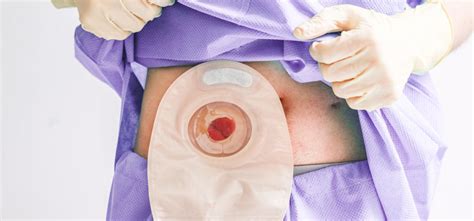 Understanding Colostomy Bags Types Uses And Care Tips