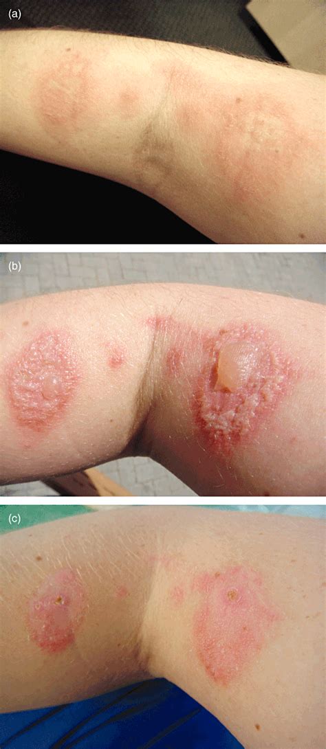 Rove Beetle Dermatitis