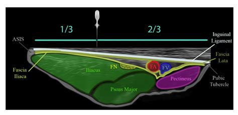 Clinical Practice Guidelines Fascia Iliaca Block Of The Femoral Nerve