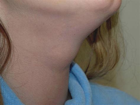 Thyroglossal Duct Cyst Thyroid Clinic Sydney