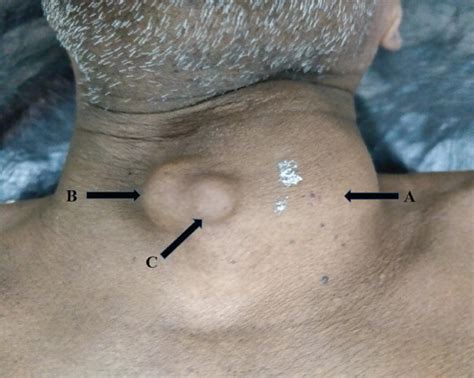An Unusual Presentation Of A Large Calcified Thyroid Nodule Jayarajah