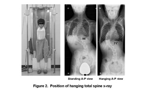 Position Of Taking Hanging Total Spine X Ray Hanging Total Spine X Ray