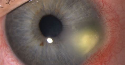 Herpes Simplex Keratitis Poses Diagnostic Challenges