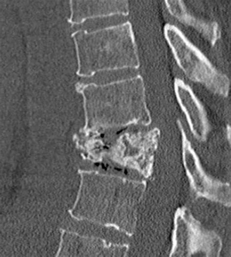 Table 1 From A Modified Posterolateral Transpedicular Approach To