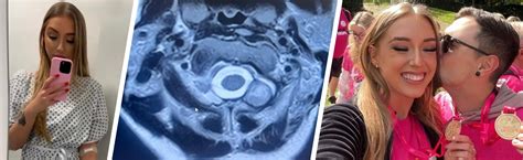 Brain Tumour Patient Marks 10 Years With 10000 Steps A Day In Februar