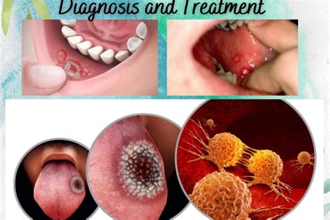 Dr Shaista Sibghat On Linkedin Mouth Ulcer Causes Symptoms