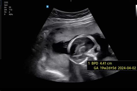 임신17주~21주 기록과 증상 신경관결손검사 태동 쥐 임신 중 질염 네이버 블로그