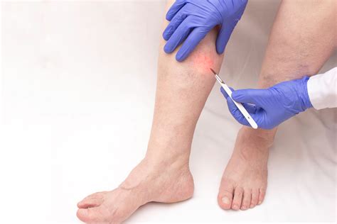Sclerotherapy Austin Voted Austins Best Vein Mds 2024 Leg Asclera