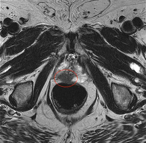 Dem Tumor Auf Der Spur Wie Die Multiparametrische Prostata Mrt Leben