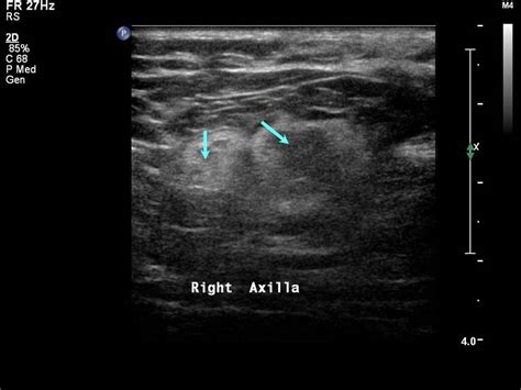 Posterior Axillary Lymph Nodes
