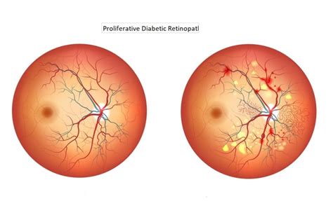 Detailed Analysis Of Proliferative Diabetic Retinopathy