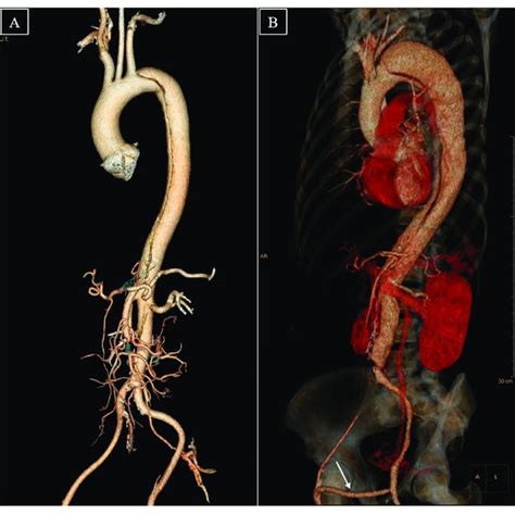 Intraoperative Image Showing The Visceral Debranching Graft With Its