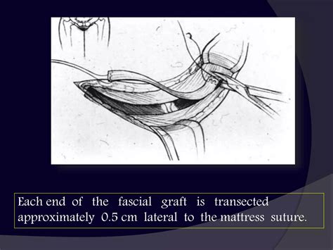 Vaginal Approach For Stress Urinary Incontinence Surgery Ppt