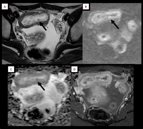 Magnetic Resonance Imaging Findings A Collapsed Unilocular Cystic