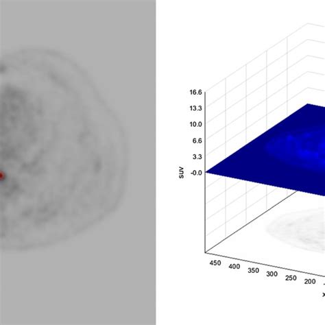 Example Of Tumor Segmentation For Extraction Of Radiomic Features From