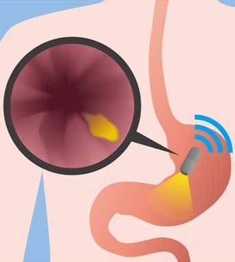Tumore Dello Stomaco Esami E Diagnosi