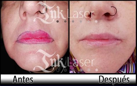 Quitar microblading y micropigmentación de cejas mal hecho