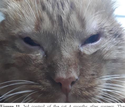 Figure 11 From Reconstruction Of Bilateral Upper Eyelid Coloboma In A
