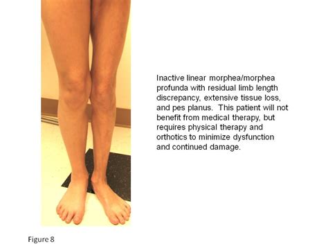 Linear Morphea