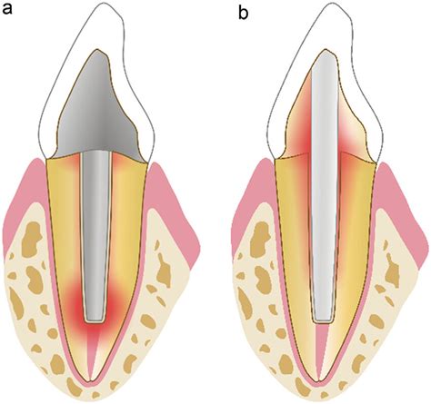 Stress Distribution Pattern In A Cast Metal Post And Core And B