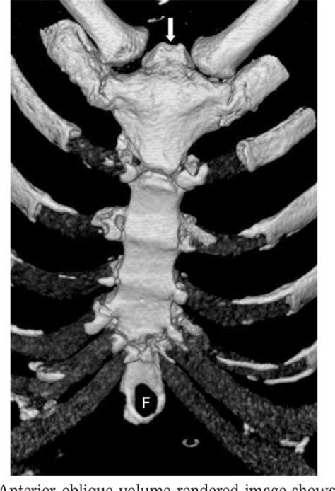 Figure 7 From Multidetector Row Ct Findings Of A Sternal Variation Semantic Scholar