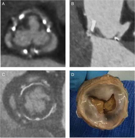 Complementary Role Of Cardiac Ct In The Assessment Of Aortic Valve