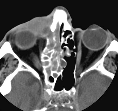 The Opacified Paranasal Sinus Approach And Differential Applied