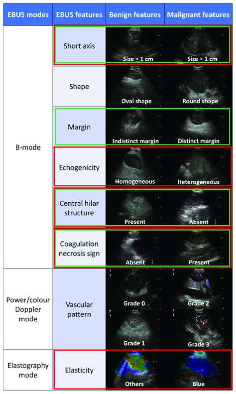 Representative Endobronchial Ultrasound Ebus Features Suggestive Of Download Scientific