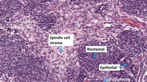 Wilms Tumor Nephroblastoma Pathology Made Simple