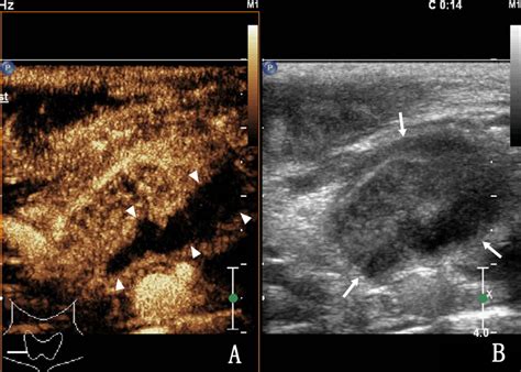 A 31 Year Old Woman With Right Cervical Lymph Node Tuberculous A Ceus Download Scientific