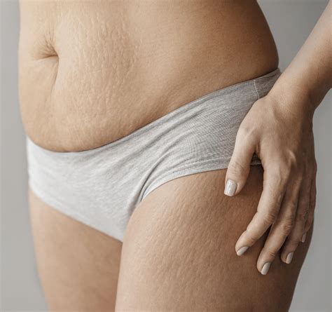 Why Do Stretch Marks Appear What You Need To Know Scar Camouflage
