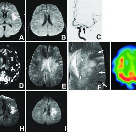 Case 2 A B Diffusion Weighted Magnetic Resonance Mr Images On