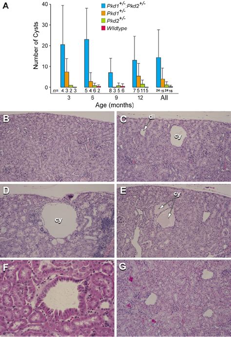 The cystic phenotype of Pkd1 þ À Pkd2 þ À mice A Cyst number