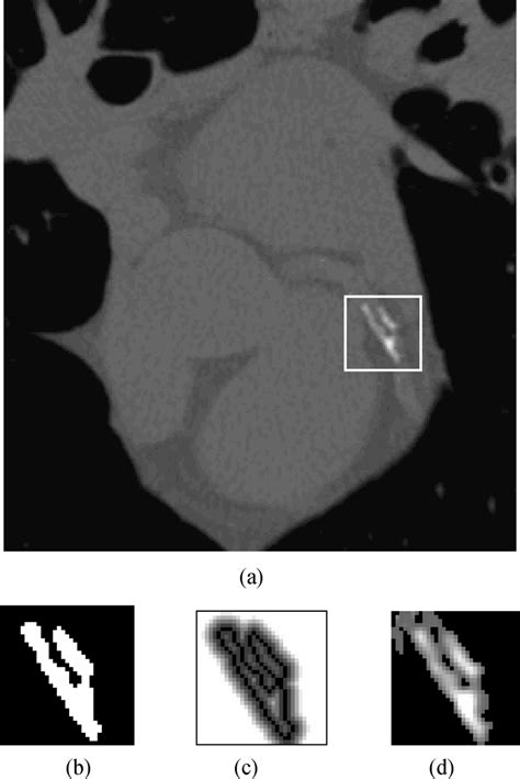 Coarse Segmentation Of Calcium Lesion A Original Ct Image B