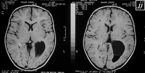 Brain Left Occipital Ventricular Cyst Radioogle