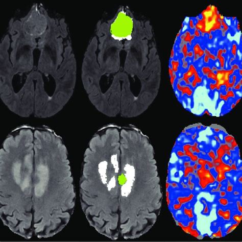 Representative Axial Slices From A 77 Year Old Male Patient A With A