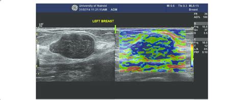 Side By Side Grey Scale And Score 2 Benign Elastogram Images Acquired