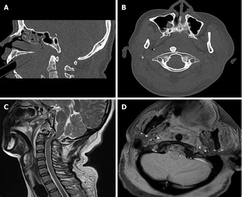 Atlantoaxial Dislocation