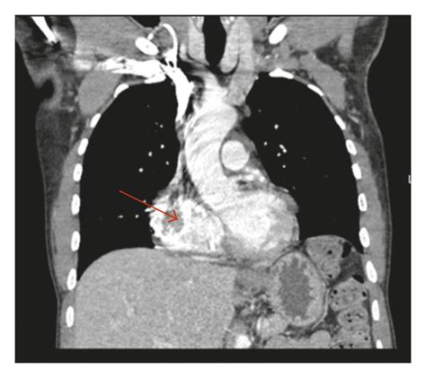 Ac Ct Imaging Of The Chest Without Contrast Illustrates Are New