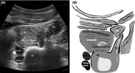 Lumbar Plexus Block