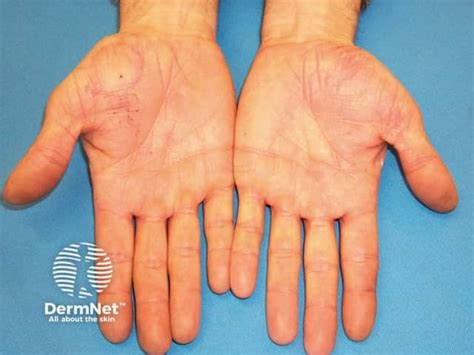 Psoriasis Hands Psoriasis Or Hand Eczema Rpsoriasis