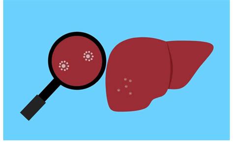 Liver Cancer Risk Factors And Prevention