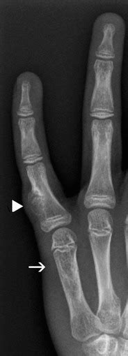 Enchondroma Of The Fifth Metacarpal Arrow And Enchondroma Protuberans Download Scientific