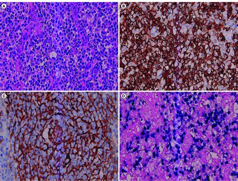 Pathological Findings Of Cervical Lymph Node Biopsy A Polymorphic