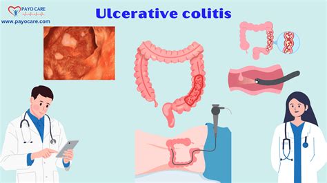 Ulcerative Colitis Causes Symptoms And Treatment Payo Care Provides