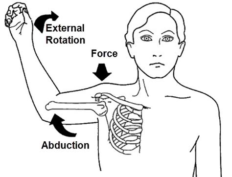 Shoulder Instability Osteomag