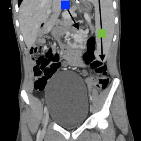 Ct Angiogram Of The Abdomen Showing Massive Jejunal Varices Blue