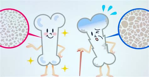 骨粗鬆症予防！予防するためには、カルシウム摂取とビタミンdを体内で合成するために必要な日光浴に加えて、ウォーキングや筋肉トレーニングなど骨に