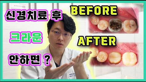 진료 리뷰 신경치료 후 금이 간 어금니 크라운 씌워서 오래 쓰자 Youtube