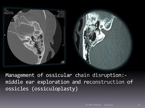 Temporal Bone Fractures